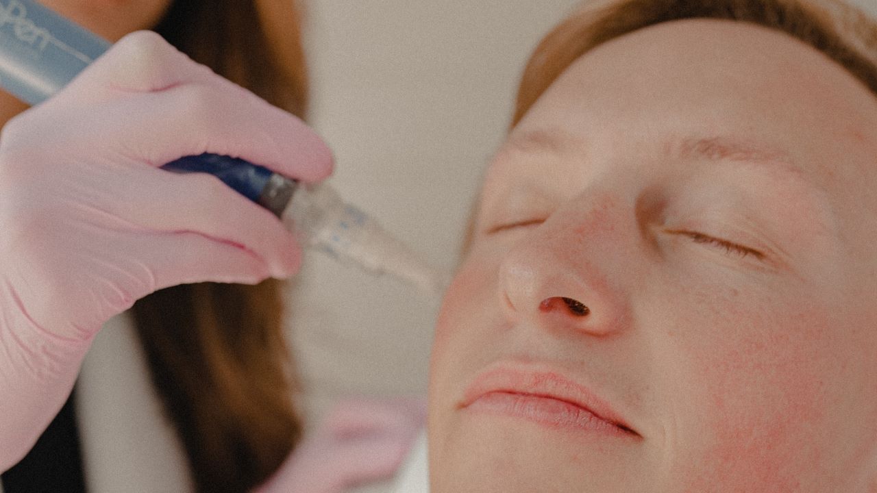 The Science of Radiofrequency Microneedling: How It Works and Why It ...