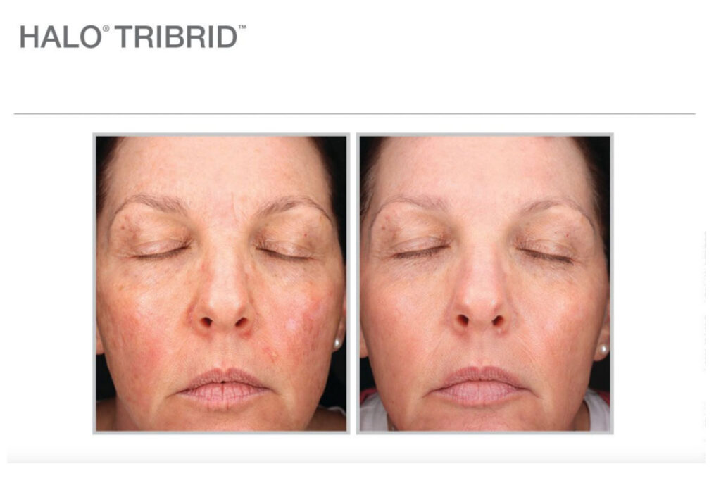 Triple-Wavelength Resurfacing: How HALO TRIBRID Works