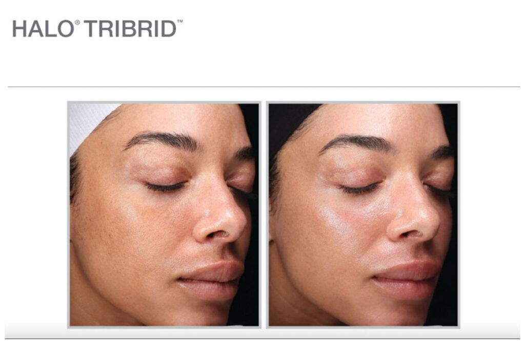 Triple-Wavelength Resurfacing: How HALO TRIBRID Works